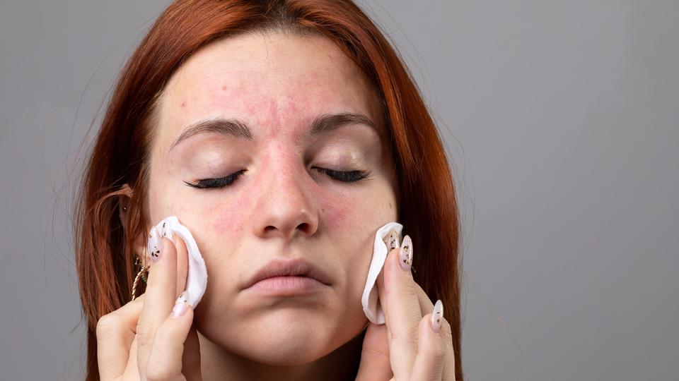 Rosacea erkennen: Ursachen, Anzeichen und Behandlung für die ...