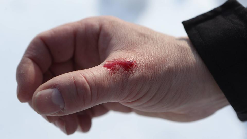 Sepsis erkennen und richtig behandeln: Ursachen, Verlauf, Symptome ...